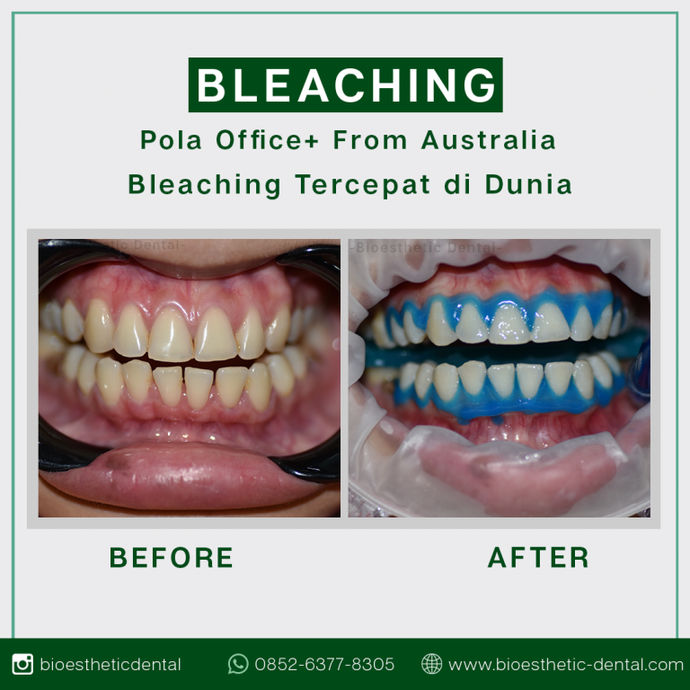 Bleaching Gigi (Teeth Whitening) – Bioesthetic Dental