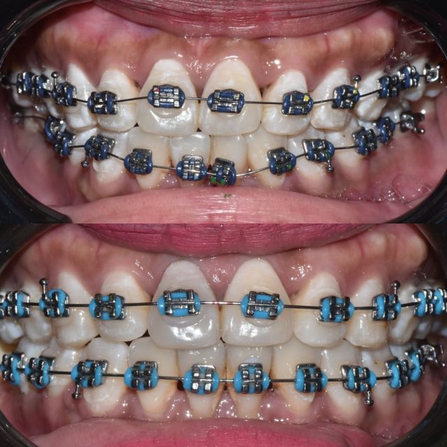 Kawat Gigi (Behel) - Bioesthetic Dental